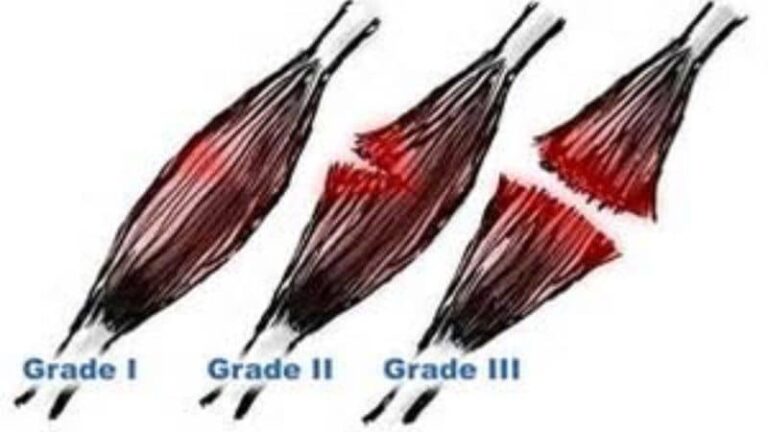 6 Best Treatments for Pulled Muscles You Must Know